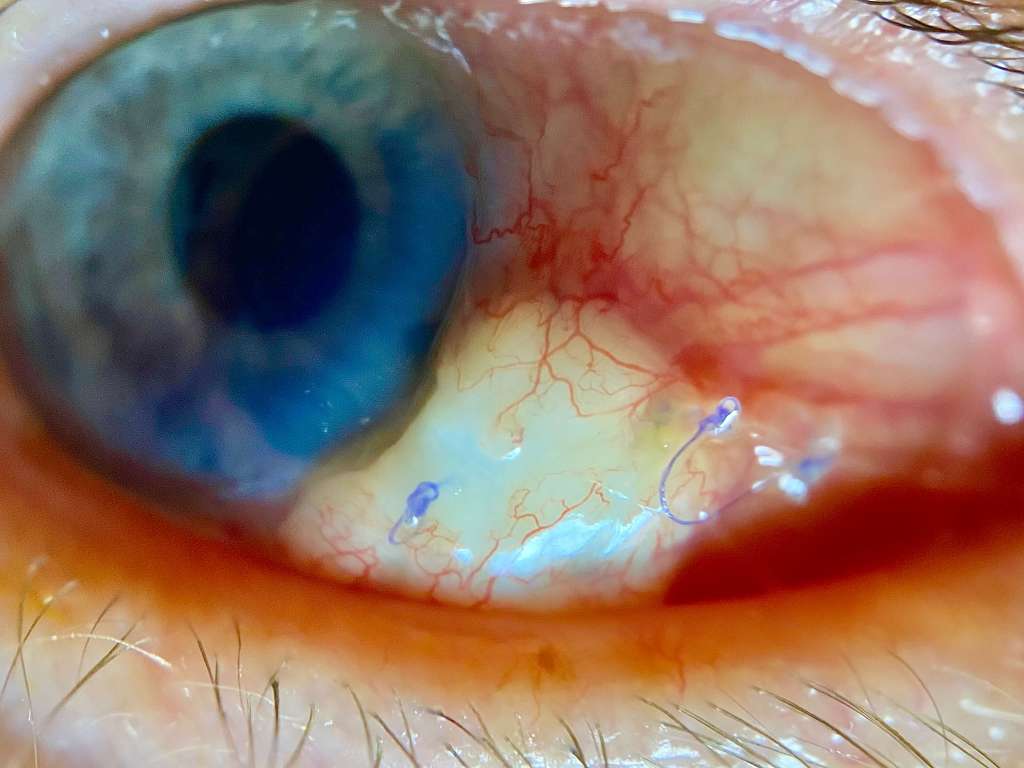 Previous Eye Surgery Repair in Woodbridge VA | 571-517-9779